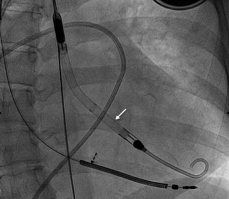 IMPELLA IS YET TO OUTSCORE THE INTRA-AORTIC BALLOON PUMP IN SEVERE ...